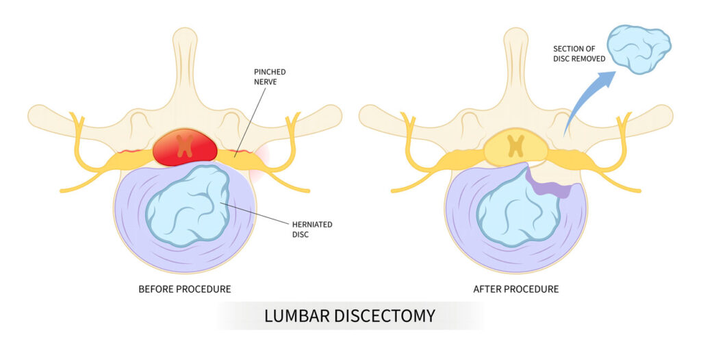 Discectomy - Luke Macyszyn